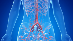 Aorto-iliac occlusive disease – Mcglade Vascular Surgery